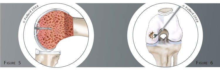 Knee cartilage surgery | Doctor Philippe Paillard Office