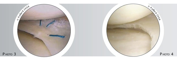 Meniscal surgery | Doctor Philippe Paillard Office