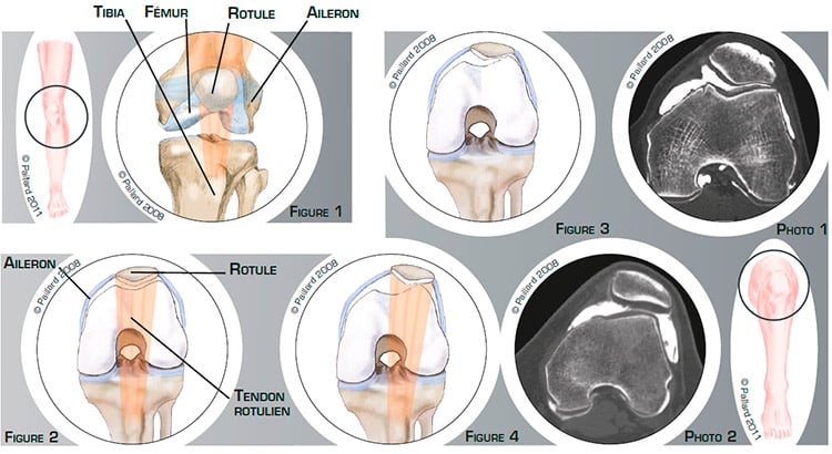 Patella realignment | Doctor Philippe Paillard Office