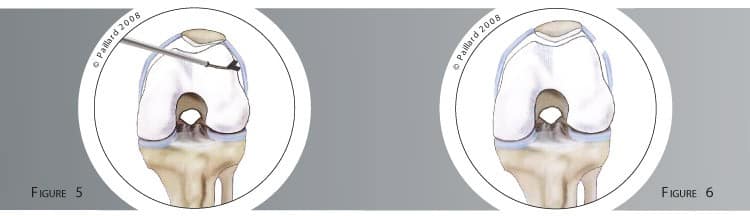Patella realignment | Doctor Philippe Paillard Office