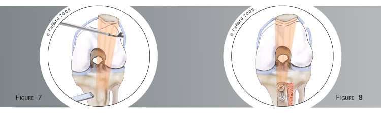 Patella realignment | Doctor Philippe Paillard Office